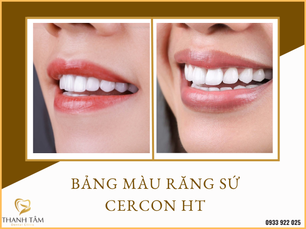 Răng Sứ Cercon HT Giá Bao Nhiêu? 3 Ưu Điểm Nổi Bật